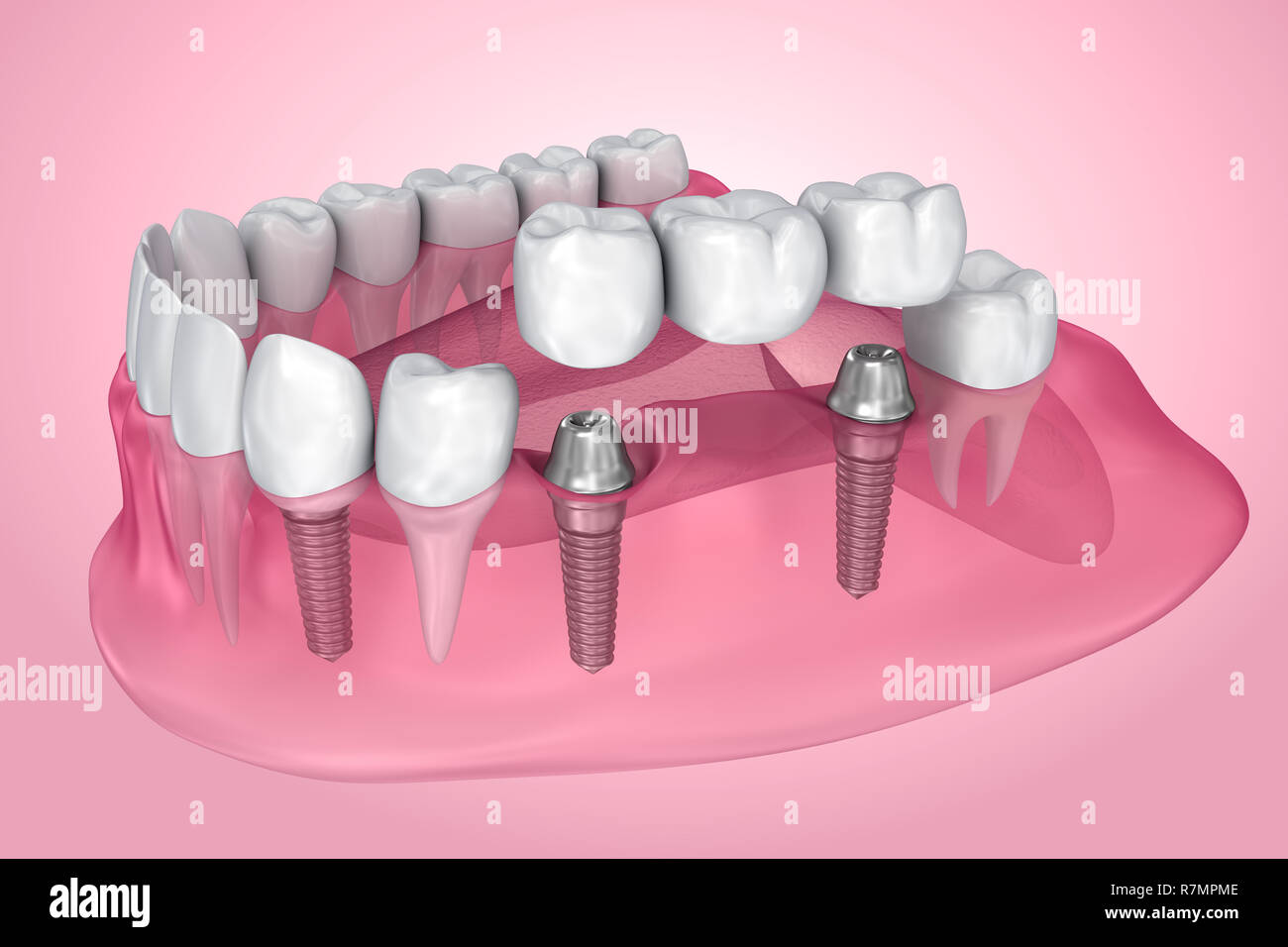 implant supported fixed bridge. Transparent view . Medically accurate ...