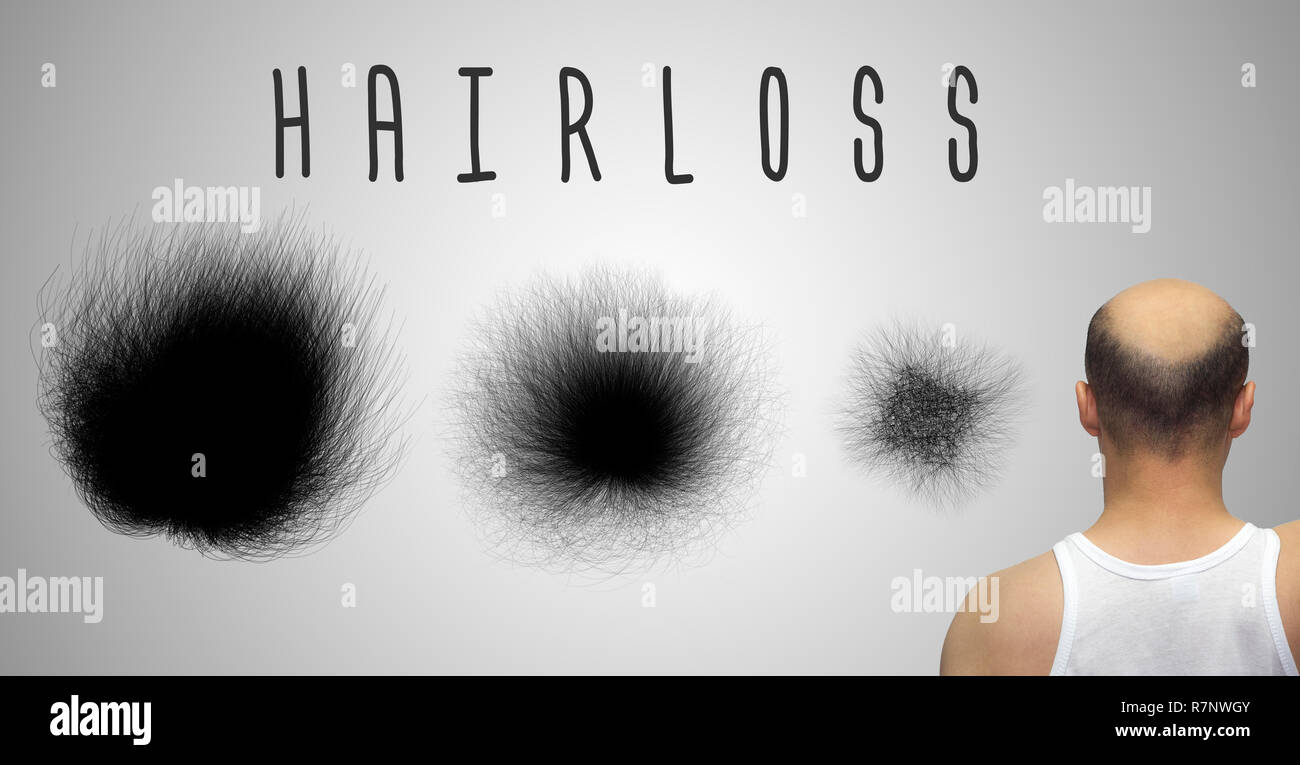 Alopecia pattern hi-res stock photography and images - Alamy