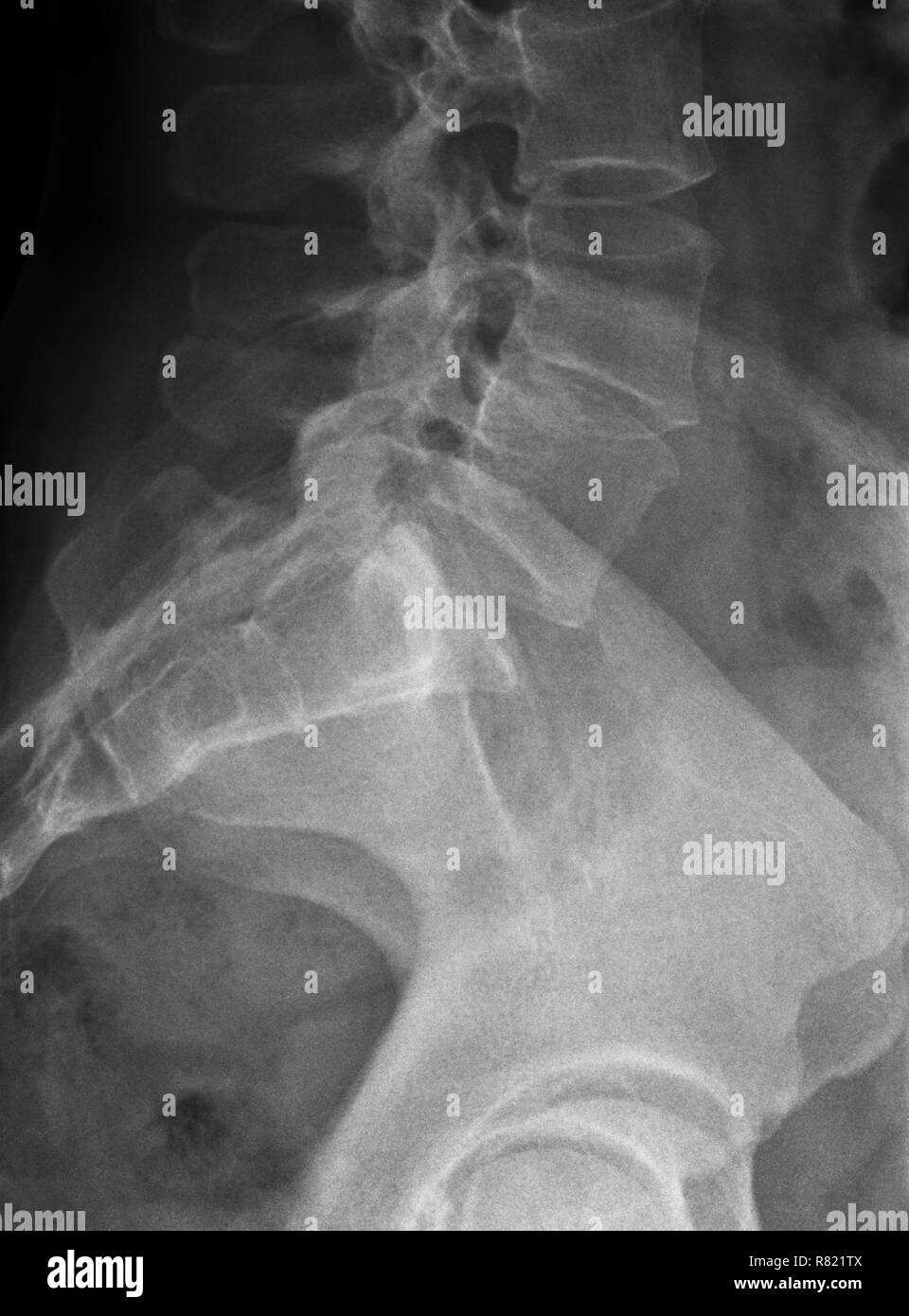 X-ray medical picture - Backbone and vertebrae Stock Photo - Alamy