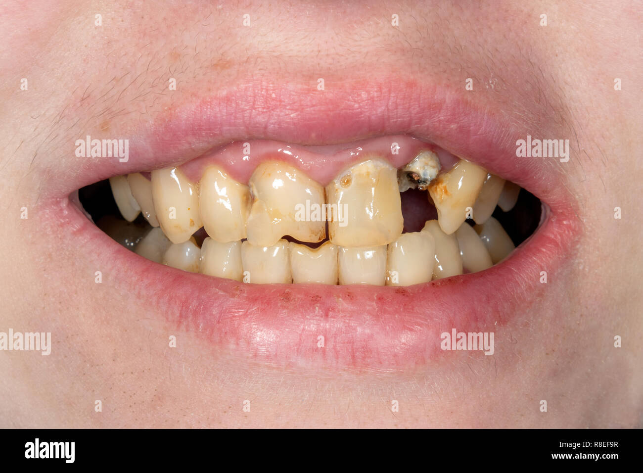 broken tooth closeup. Girl at the dental reception Stock Photo - Alamy