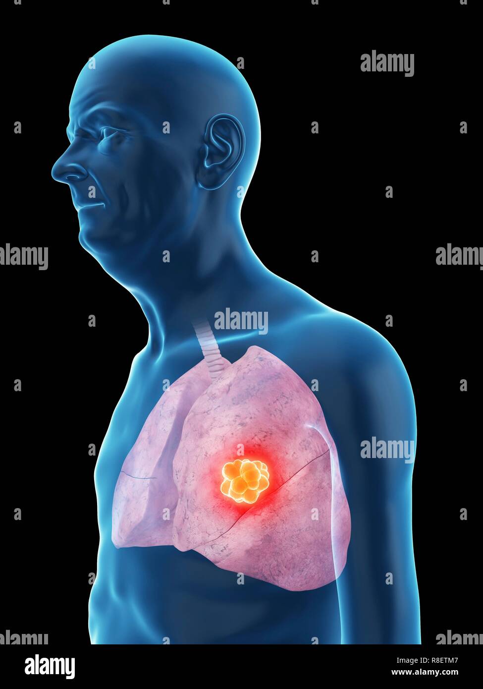 Illustration of an old man's lung cancer Stock Photo - Alamy