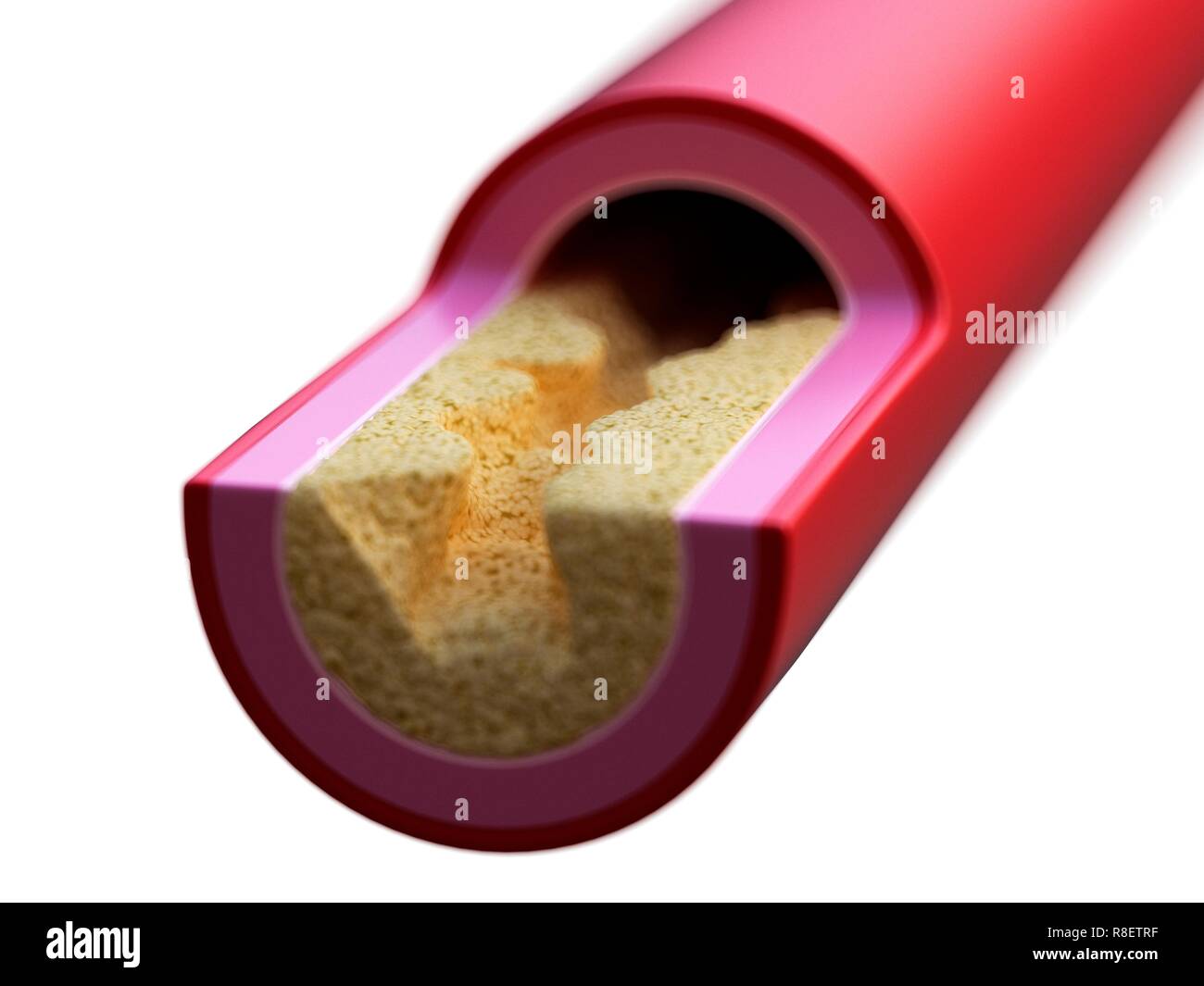 Blocked coronary artery hi-res stock photography and images - Alamy