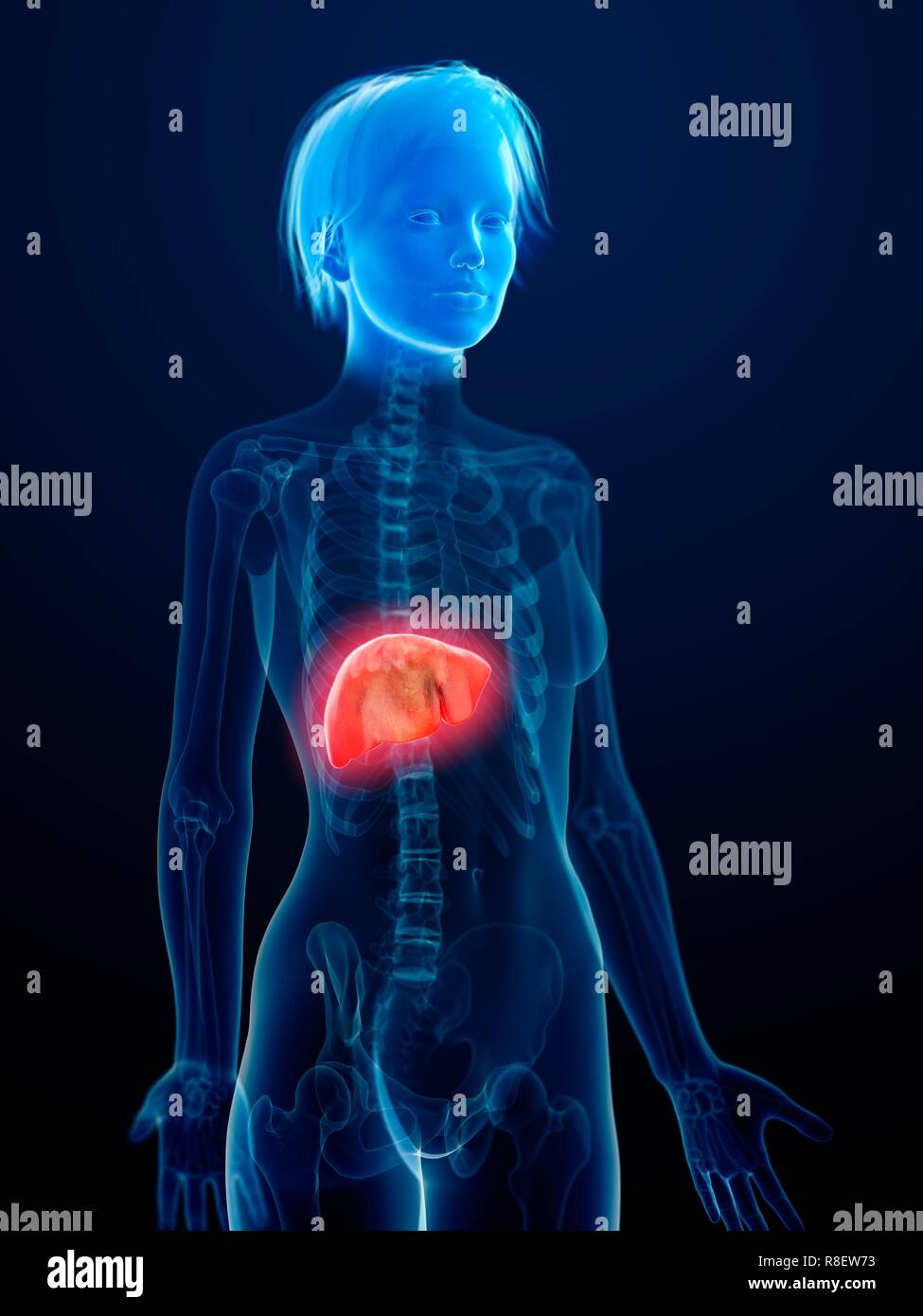 Illustration of an inflamed liver Stock Photo - Alamy