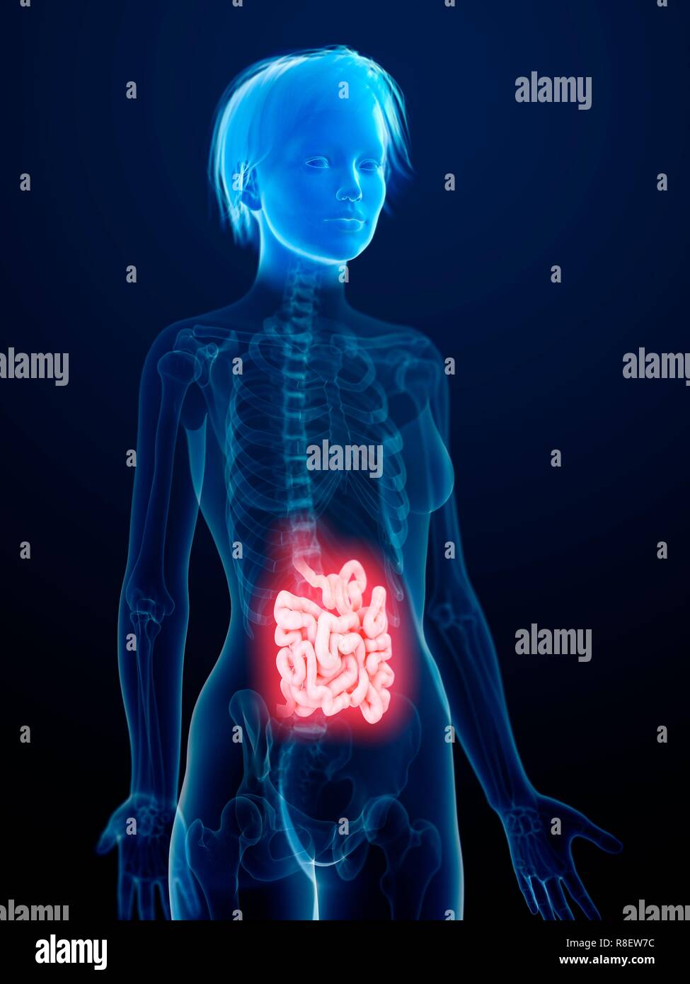 Illustration of an inflamed small intestine Stock Photo - Alamy