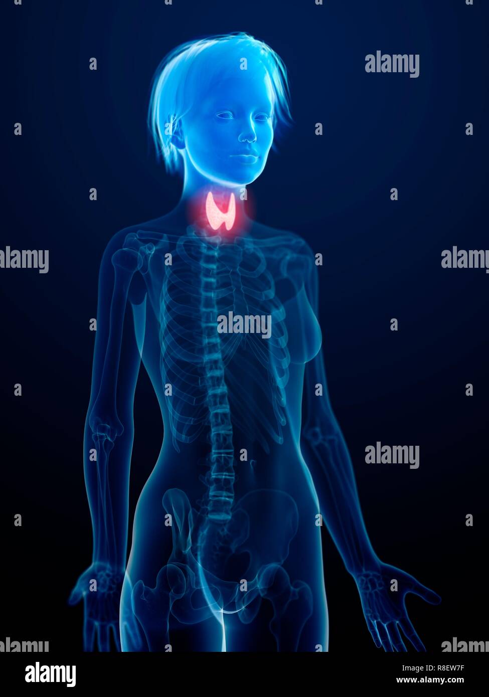 Illustration of an inflamed thyroid gland Stock Photo - Alamy
