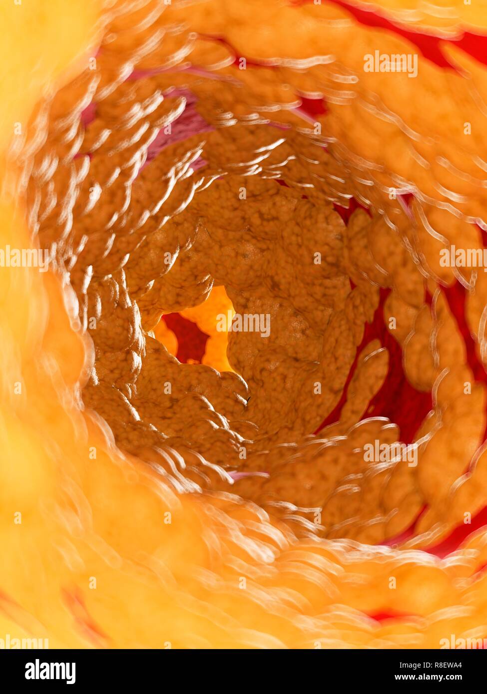 Illustration of fat inside of an artery Stock Photo - Alamy
