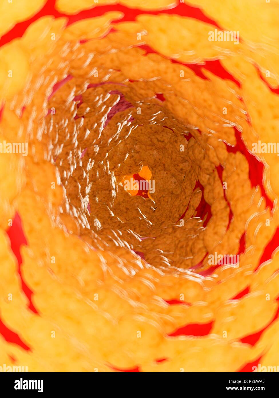 Illustration of fat inside of an artery Stock Photo - Alamy