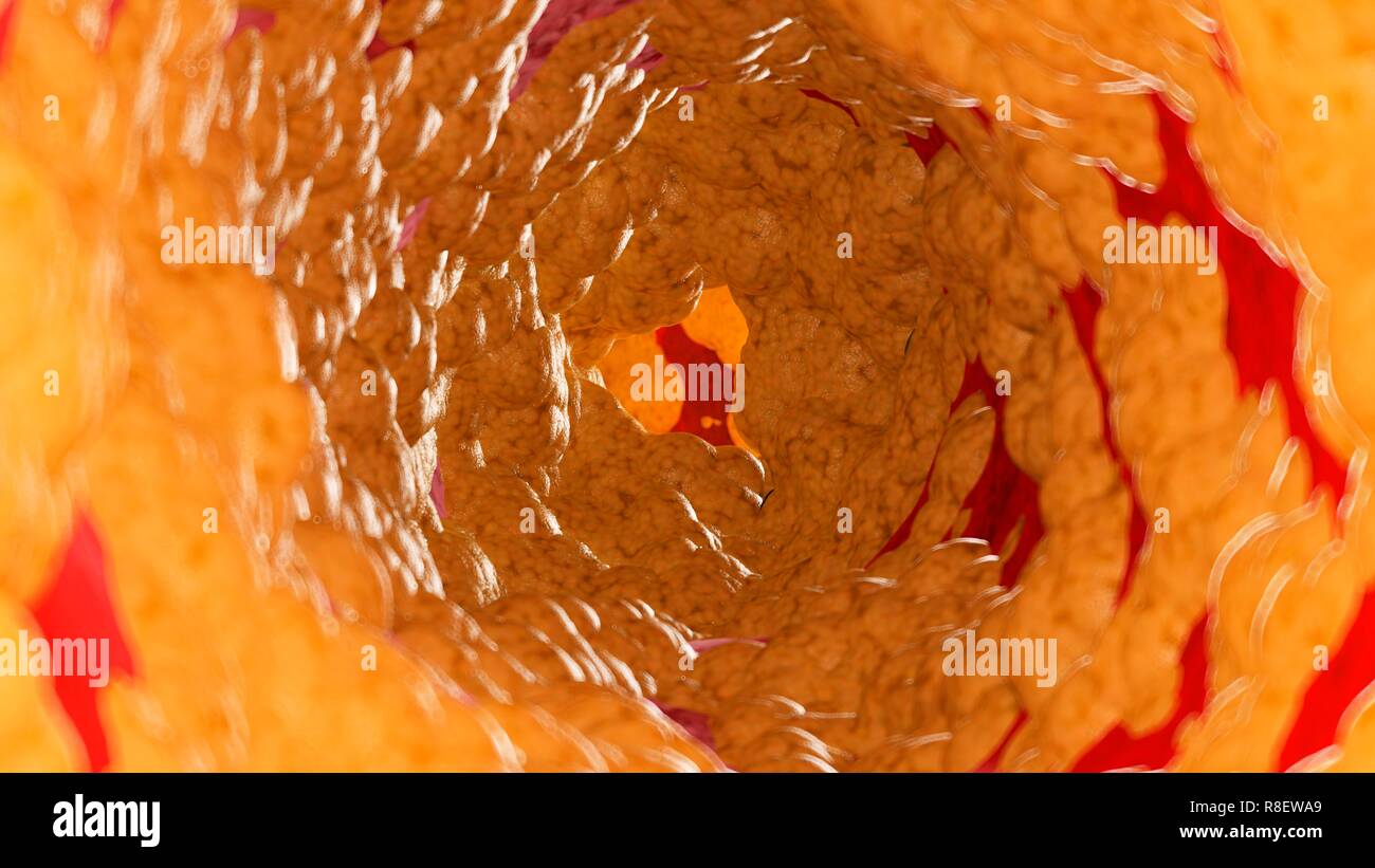 Illustration of fat inside of an artery Stock Photo - Alamy