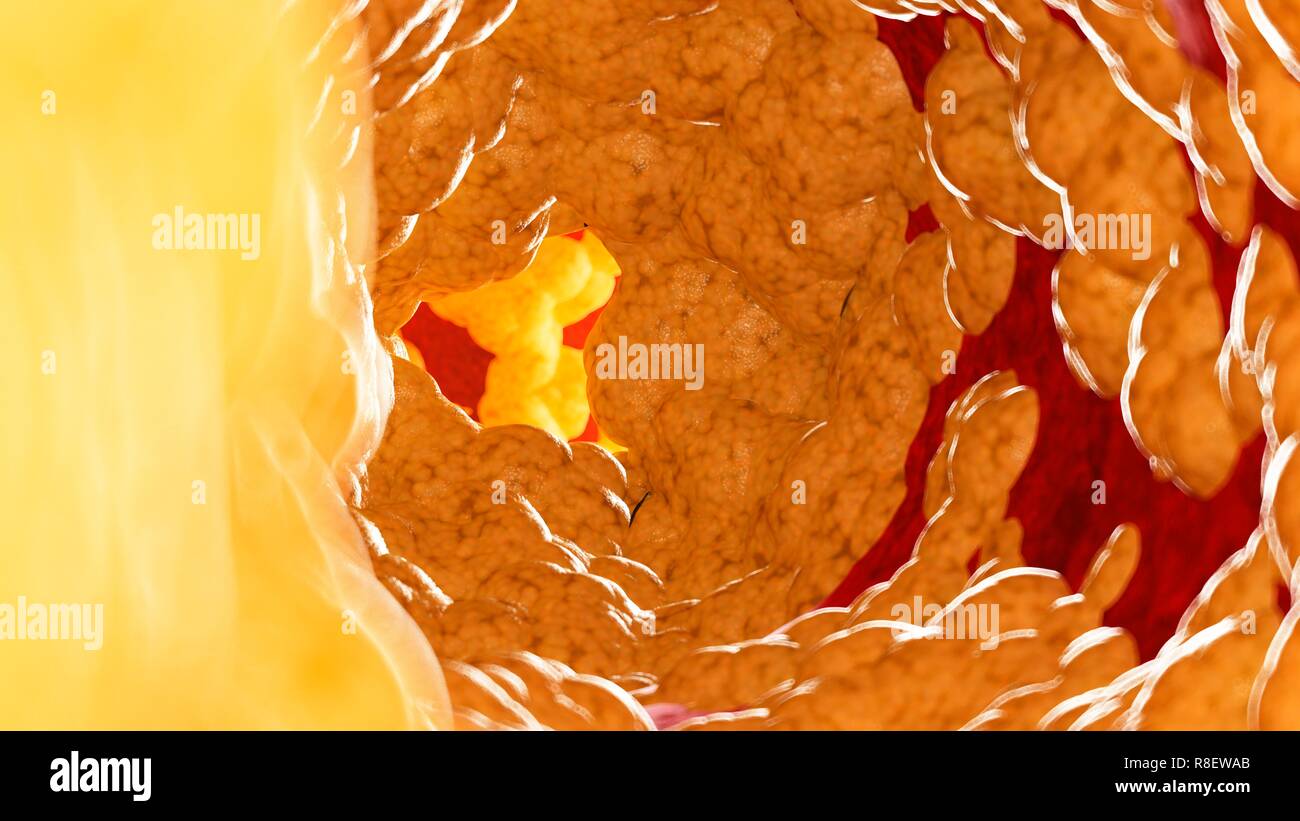 Illustration of fat inside of an artery Stock Photo - Alamy