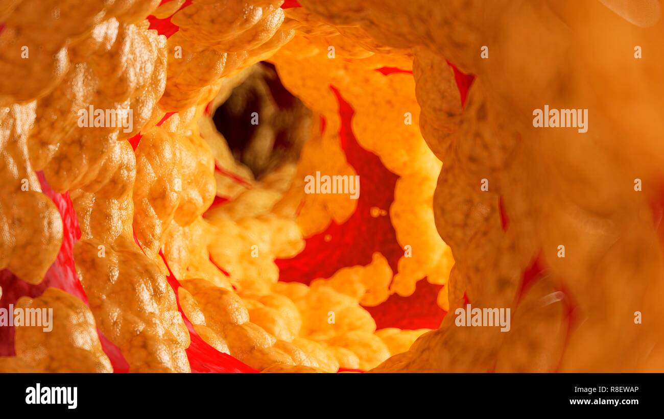 Illustration of fat inside of an artery Stock Photo - Alamy