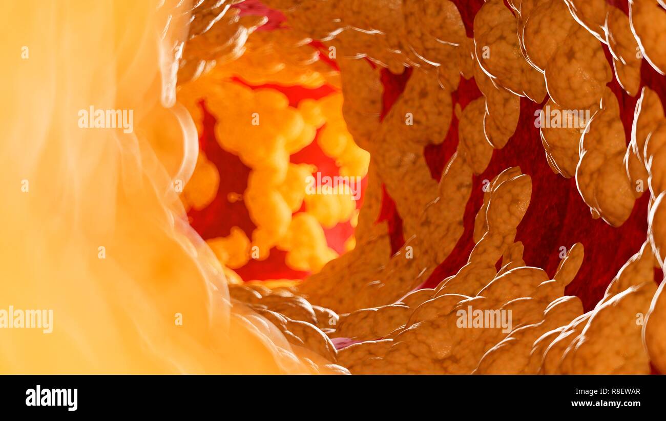 Illustration of fat inside of an artery Stock Photo - Alamy