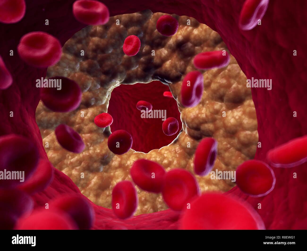 Illustration of a blocked artery Stock Photo - Alamy