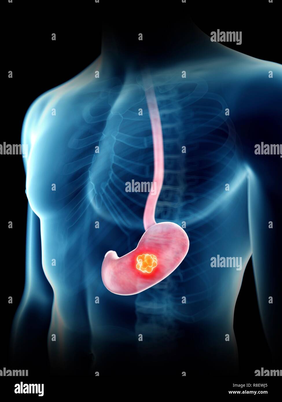 Stomach tumor hi-res stock photography and images - Alamy