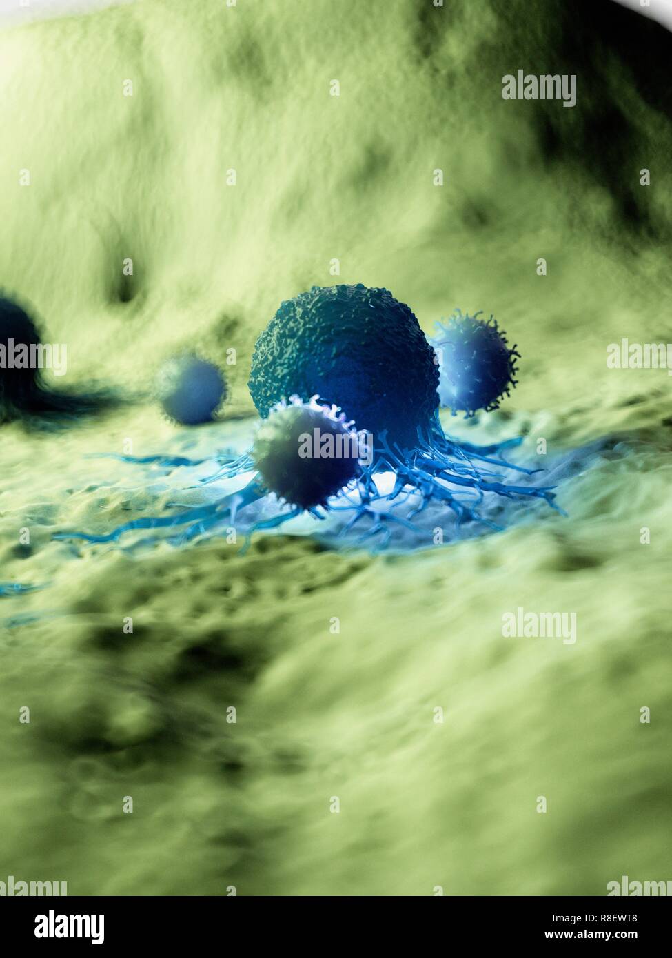 Illustration of a cancer cell being attacked by white blood cells Stock ...
