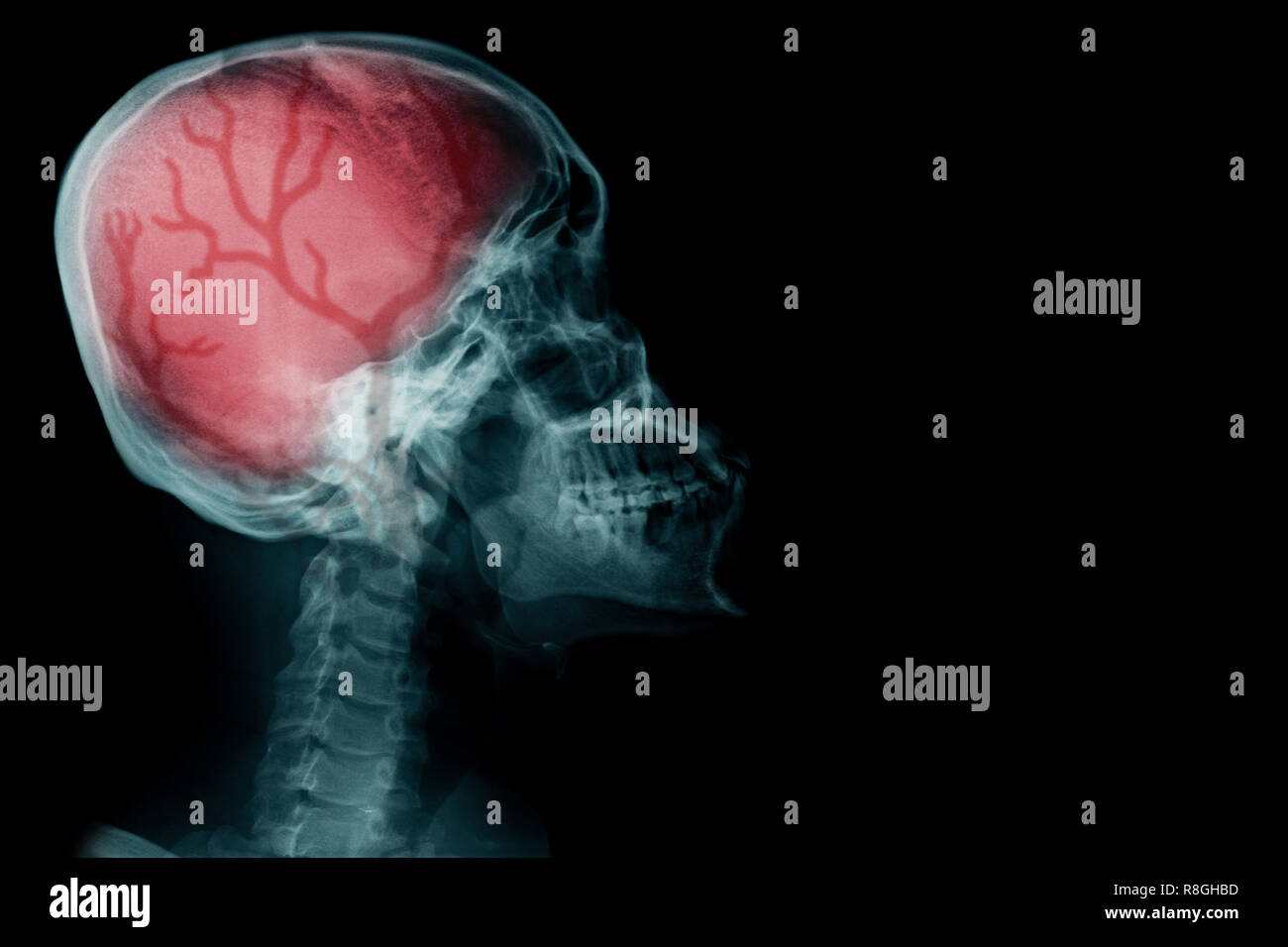 Blood vessels brain x ray hi-res stock photography and images - Alamy