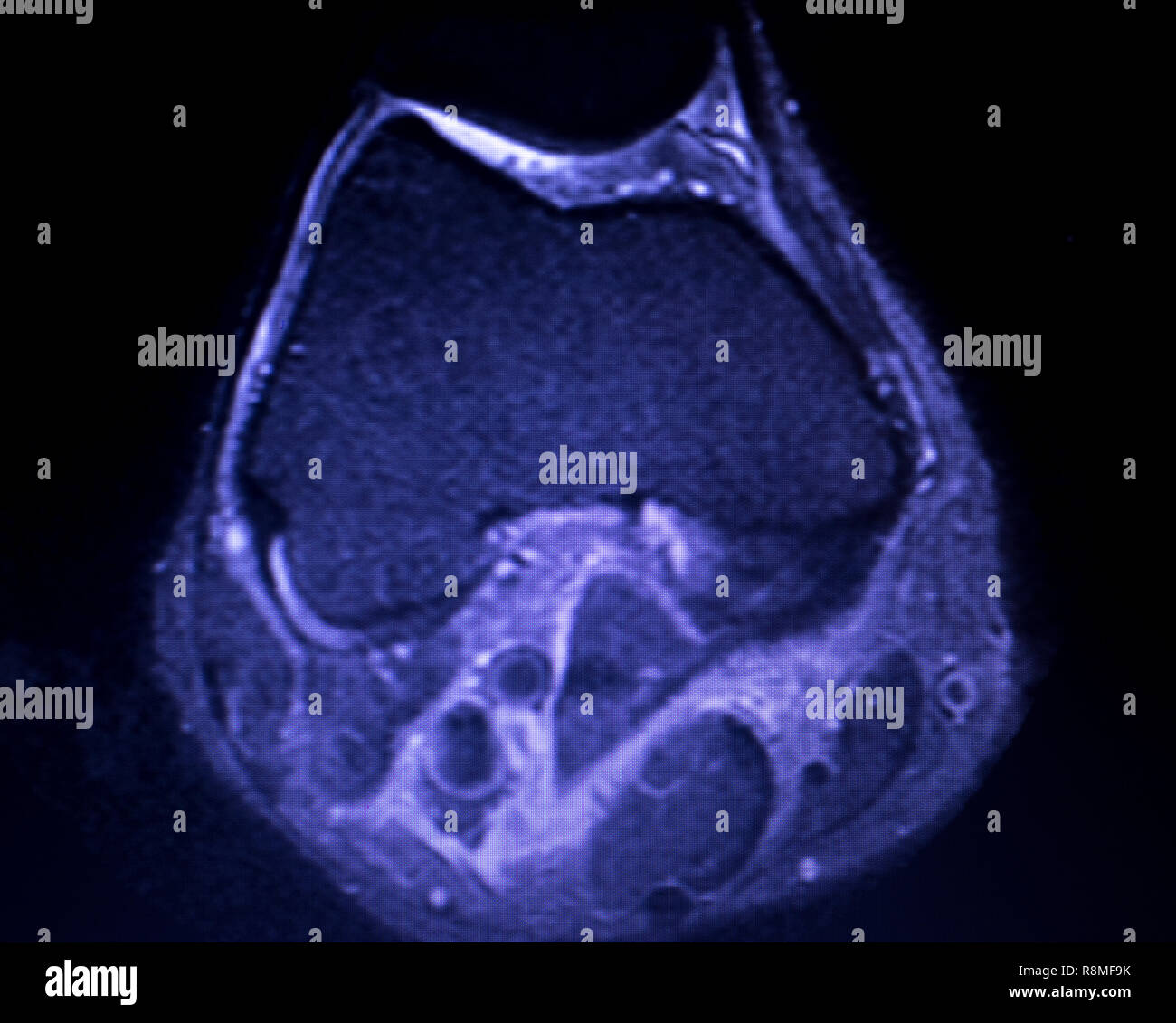 Magnetic resonance imaging MRI knee posterior horn medial meniscus tear ...