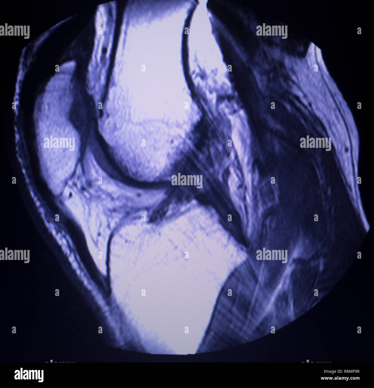 Magnetic resonance imaging MRI knee posterior horn medial meniscus tear ...