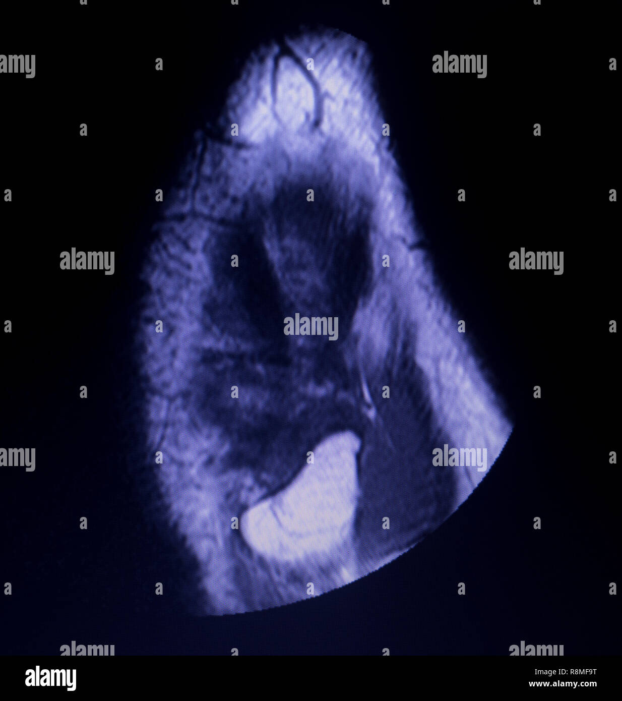 Magnetic resonance imaging MRI knee posterior horn medial meniscus tear ...