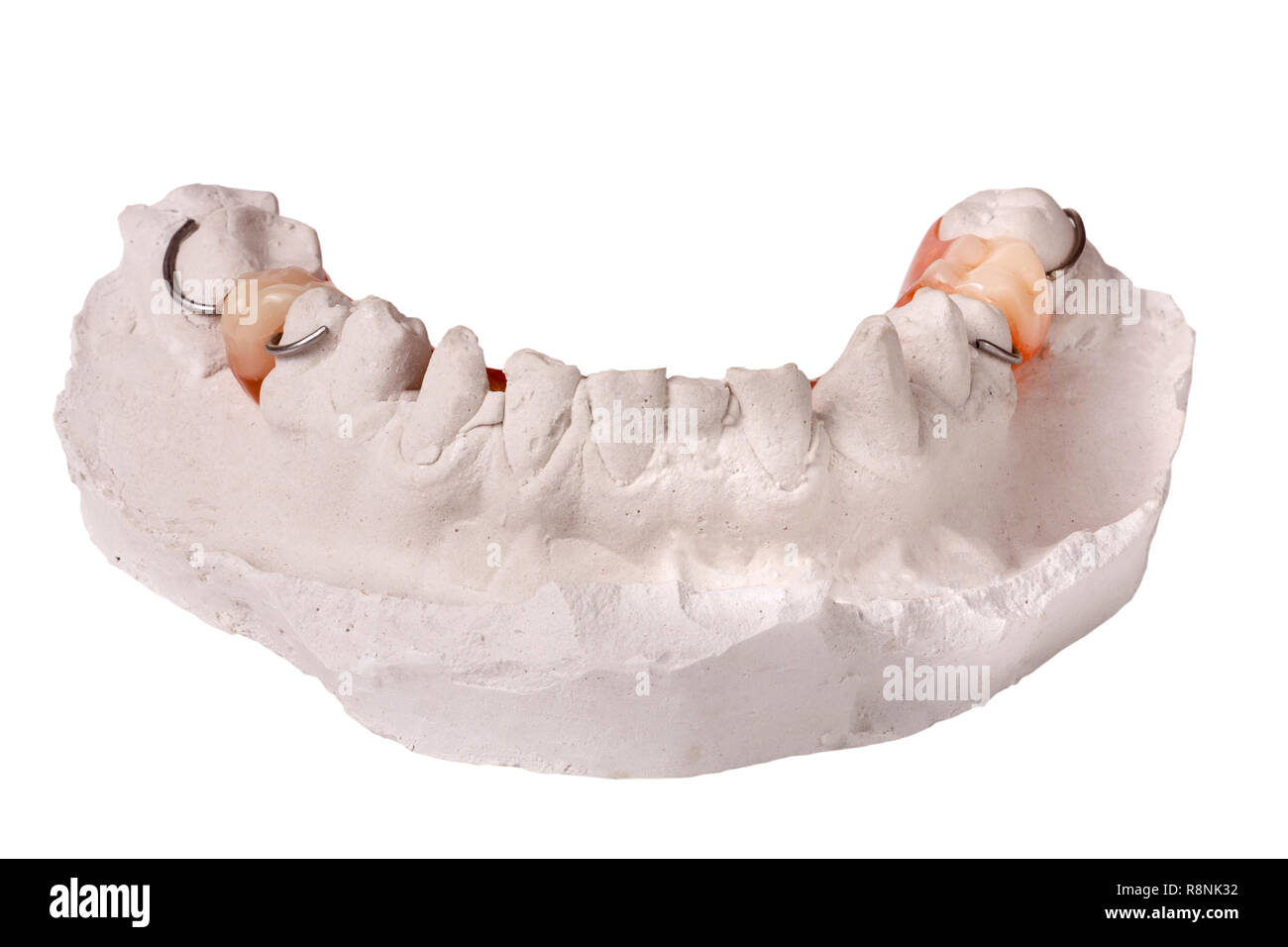 plaster cast of teeth with removable partial denture isolated on white ...