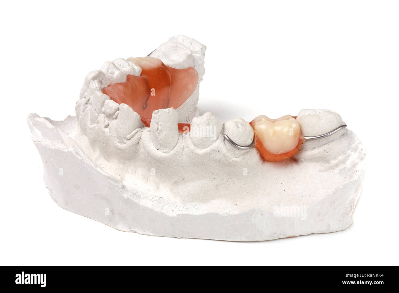 plaster cast of teeth with removable partial denture isolated on white ...