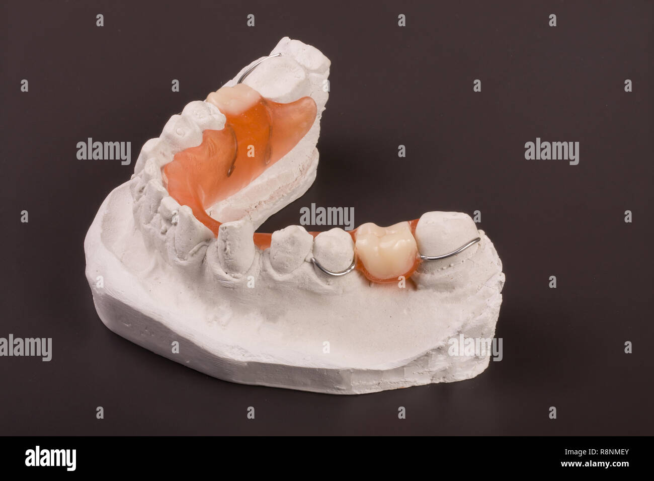 plaster cast of teeth with removable partial denture on a dark ...