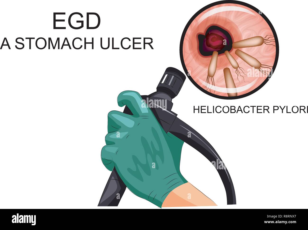 Duodenal Ulcer Stock Photos & Duodenal Ulcer Stock Images - Alamy