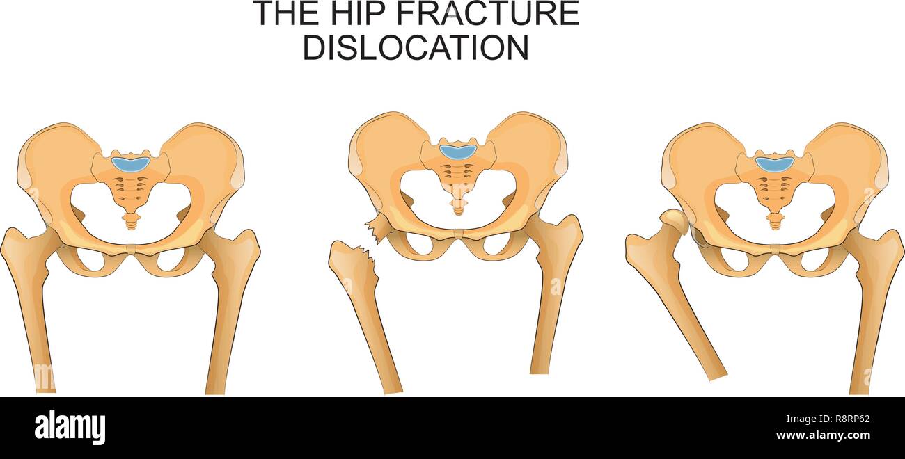 Vector Illustration Of A Pelvis Hip Fracture Hip Dislocation Stock