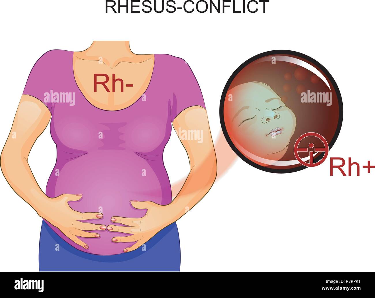vector illustration of RH-conflict pregnant. negative RH factor mother ...