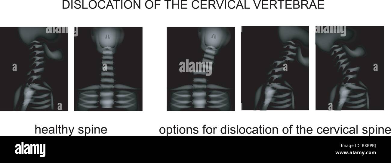 vector illustration of a dislocation of the spine Stock Vector Image ...