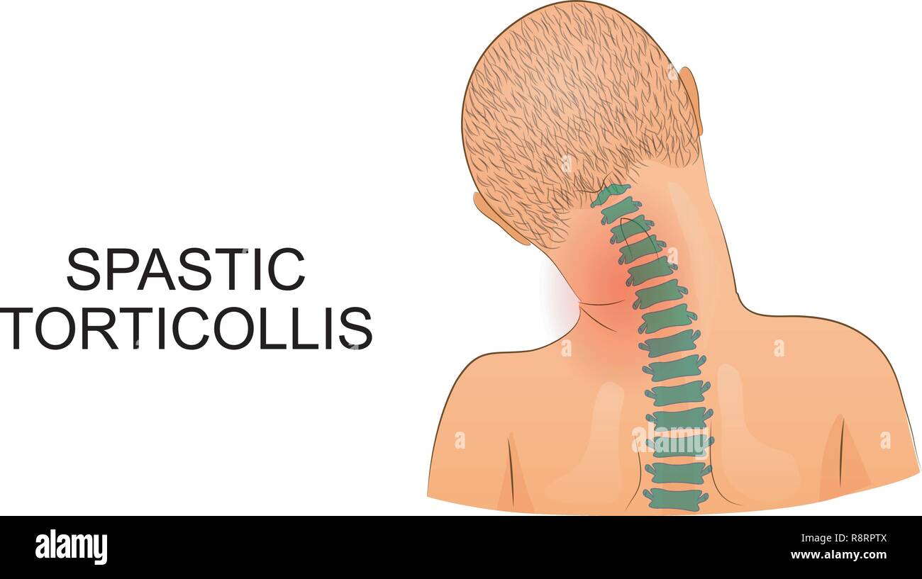 Spasmodic Torticollis