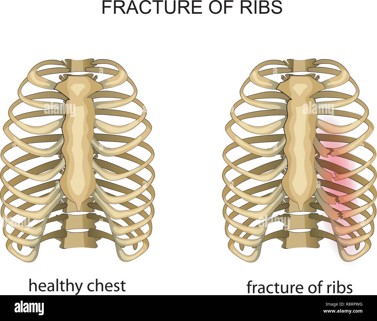 vector illustration of broken ribs chest thorax Stock Vector Image ...