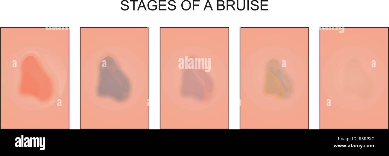 Ecchymosis hi-res stock photography and images - Alamy