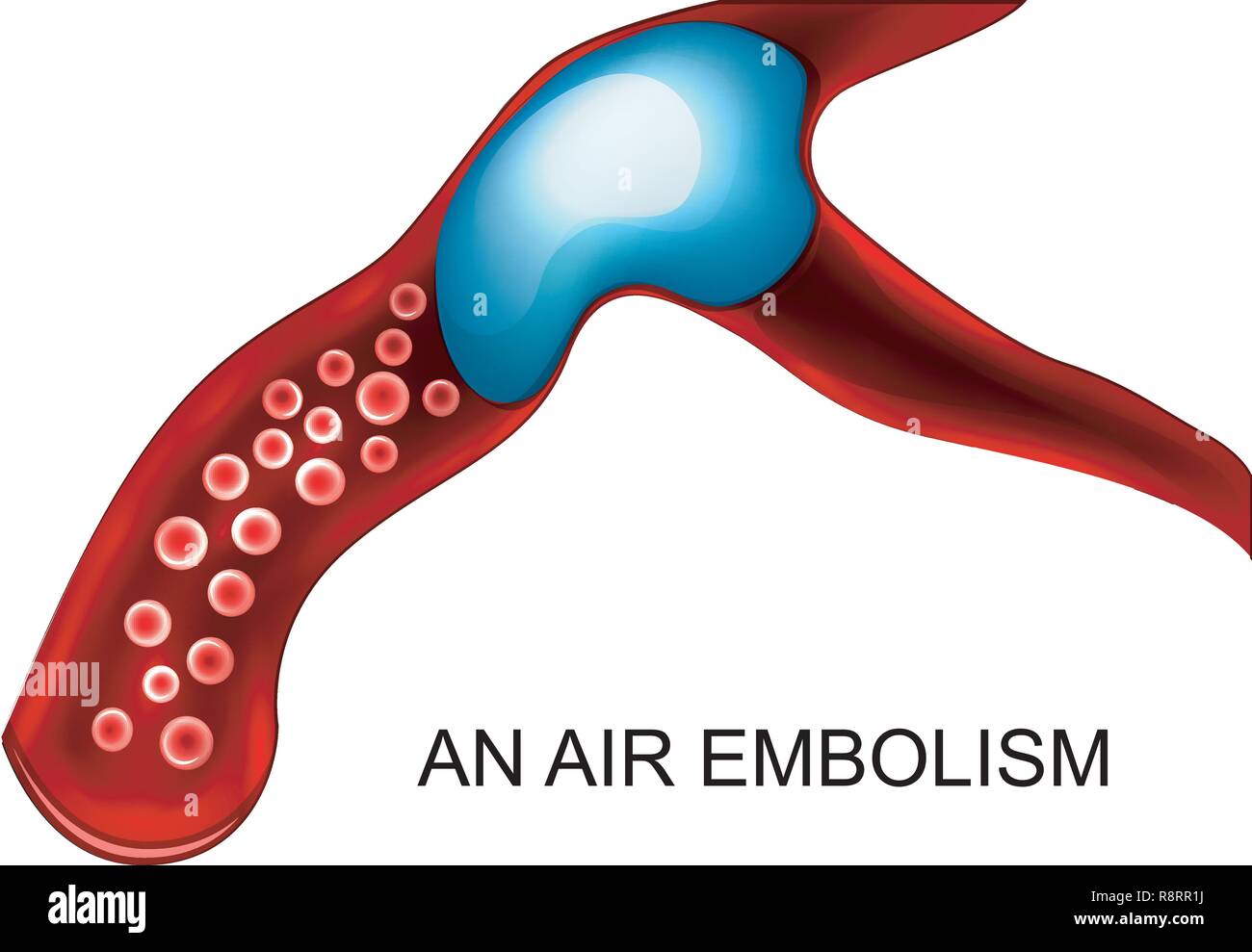 Air embolism hi-res stock photography and images - Alamy