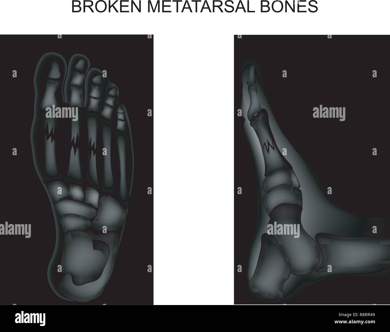 vector illustration of fractures of the metatarsal bones of the foot ...