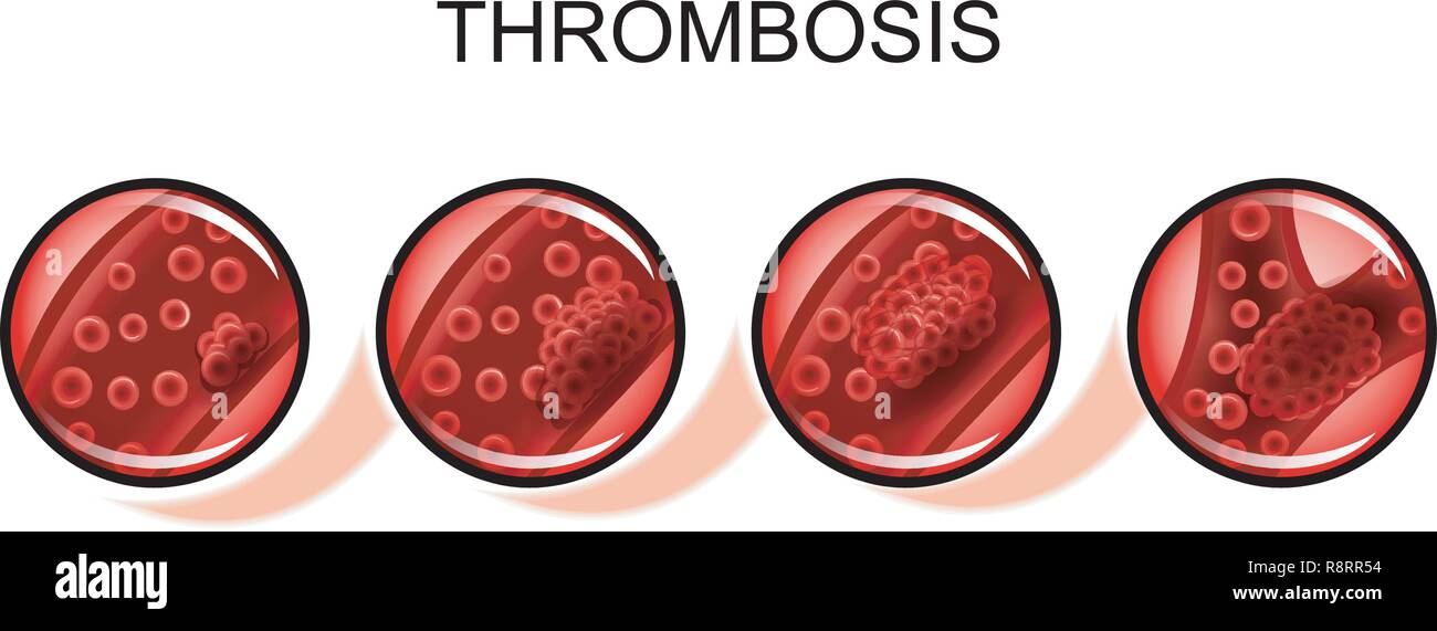 Coagulum hi-res stock photography and images - Alamy