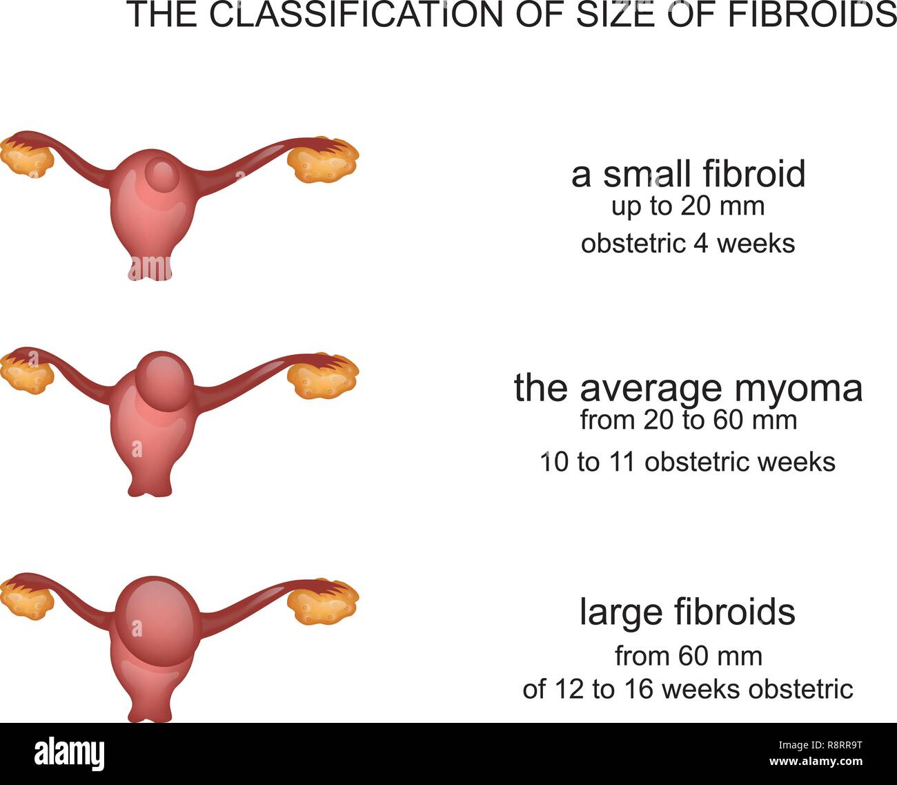 vector illustration of uterine fibroids by week pregnancy Stock Vector ...