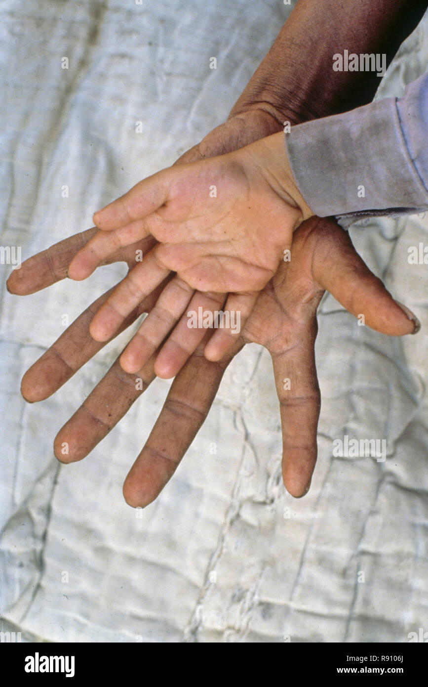 Six finger family, boy hand on man hand palm, photo feature, india ...