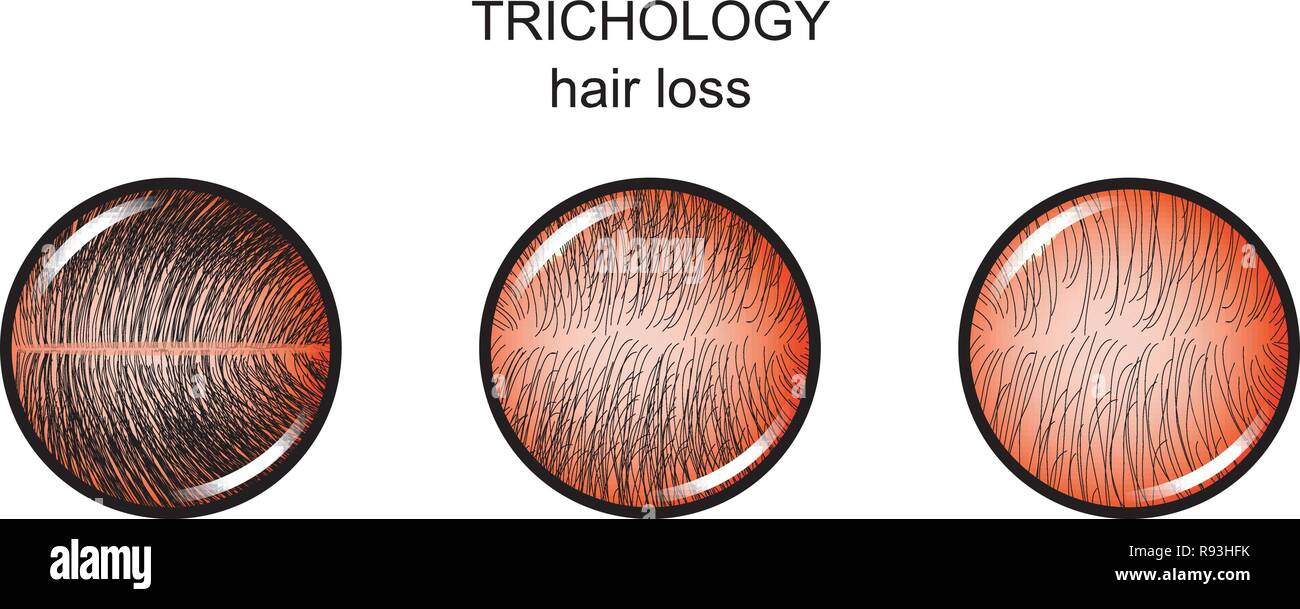 vector illustration of trichology. hair loss. dermatology Stock Vector ...