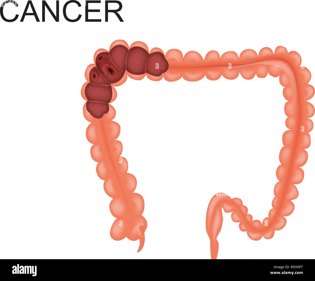 vector illustration of colon cancer is a sectional view Stock Vector ...