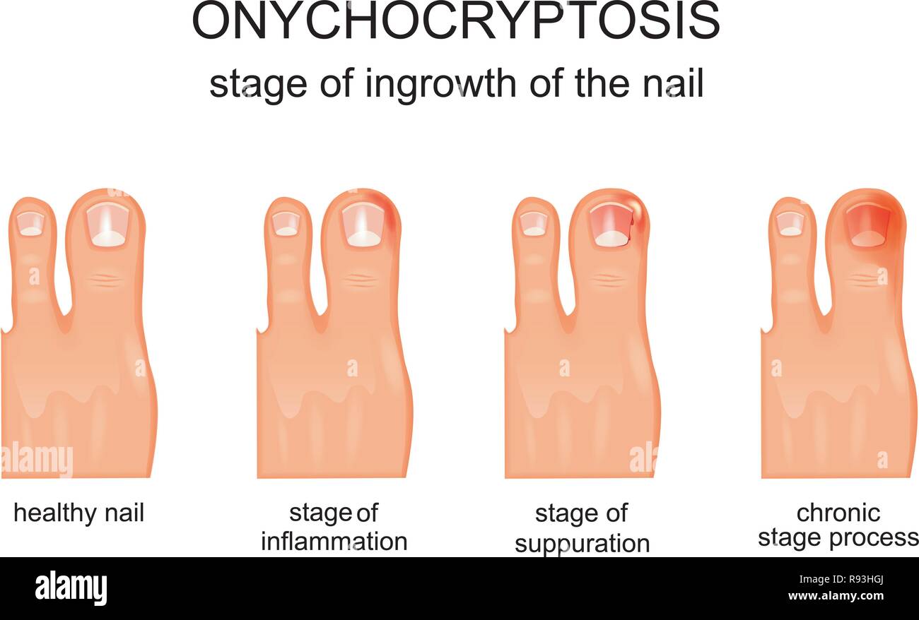 Ingrown nail hi-res stock photography and images - Alamy