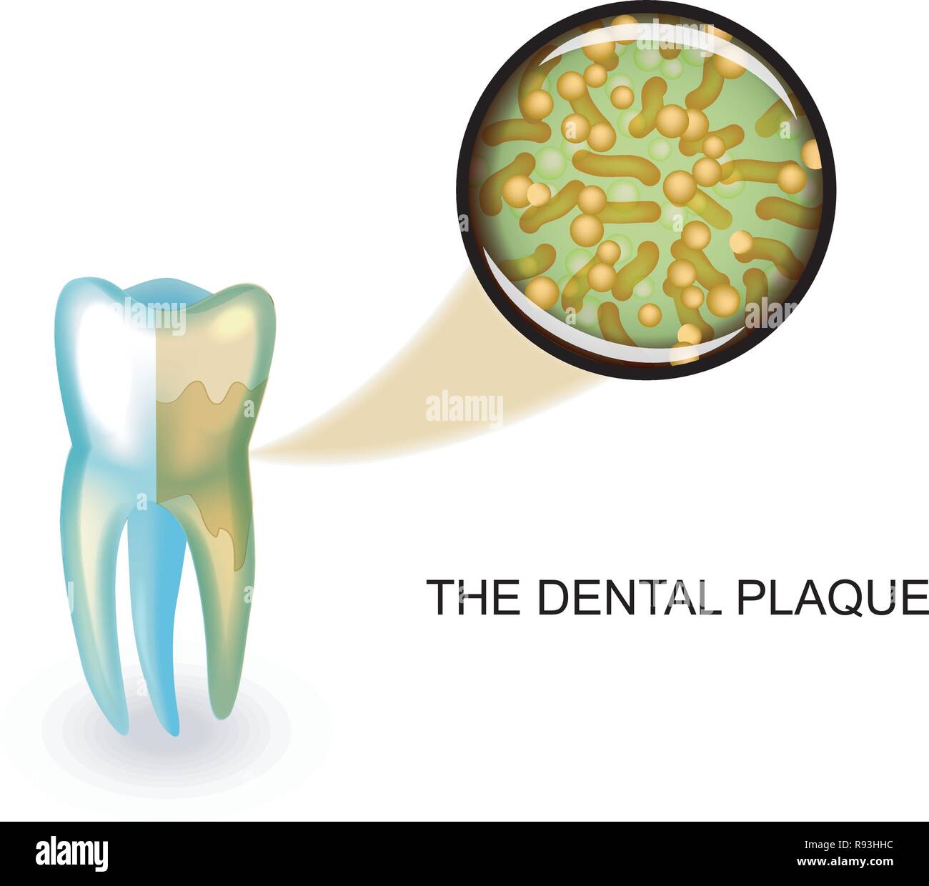 vector illustration of dental plaque. microbes under magnification ...