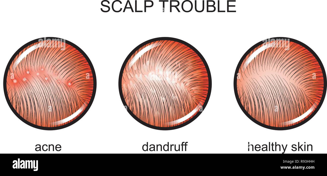 Dry scalp hi-res stock photography and images - Alamy