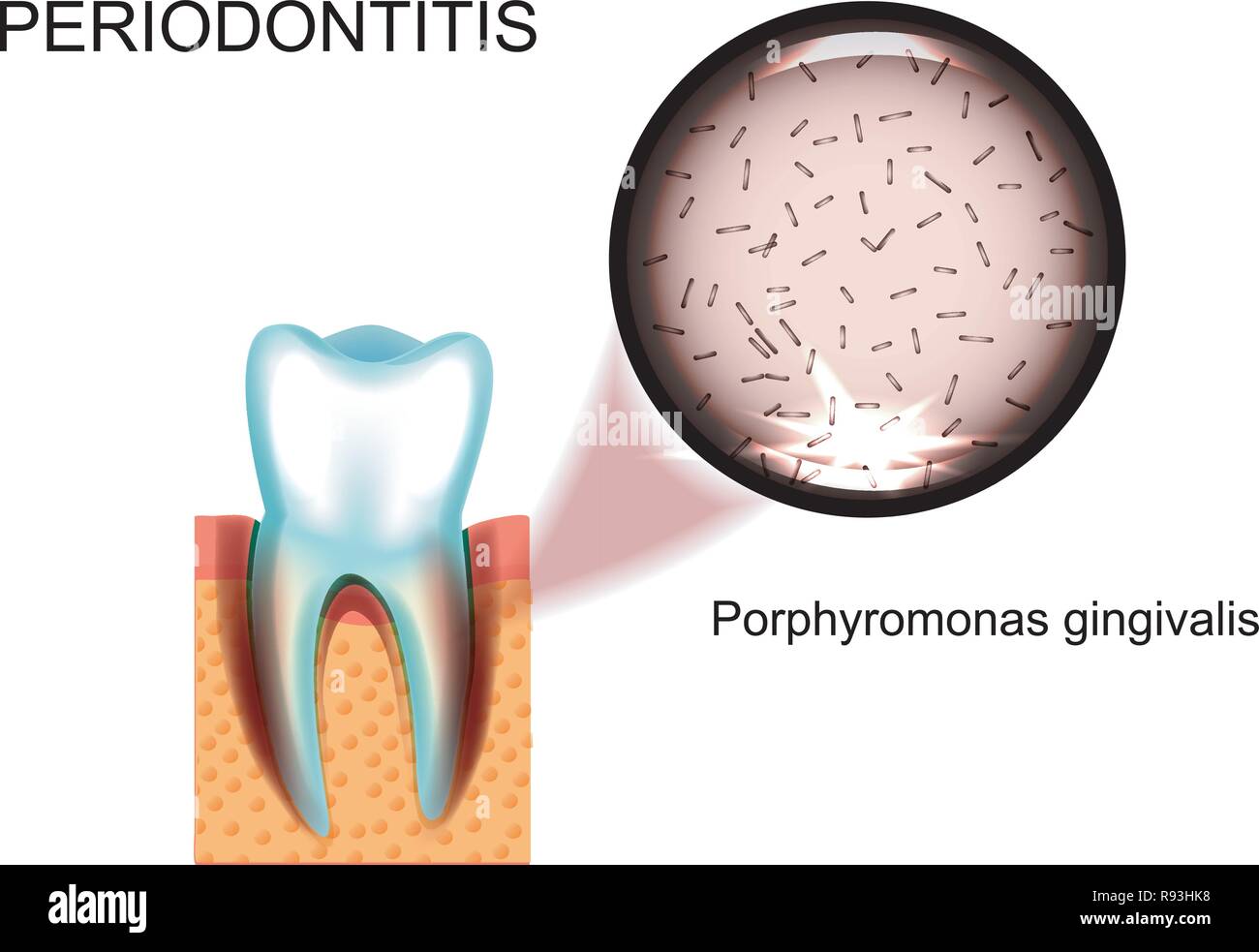 vector illustration of periodontitis. Porphyromonas gingivalis ...