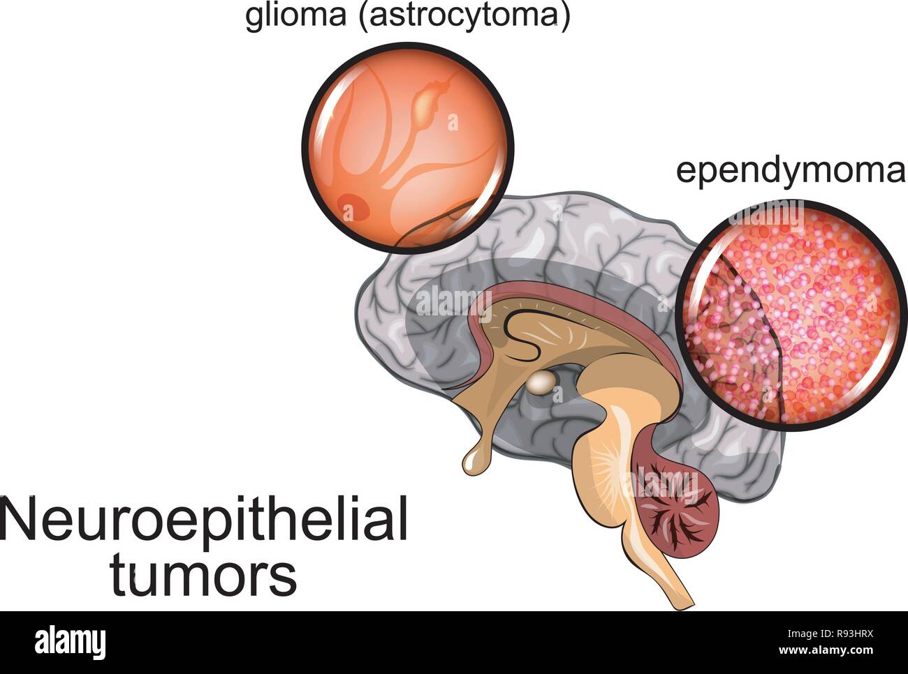 Primary cerebral tumor hi-res stock photography and images - Alamy