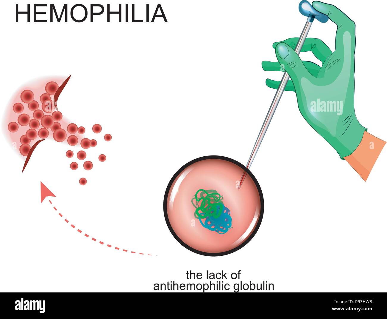 Pathological process Stock Vector Images - Alamy