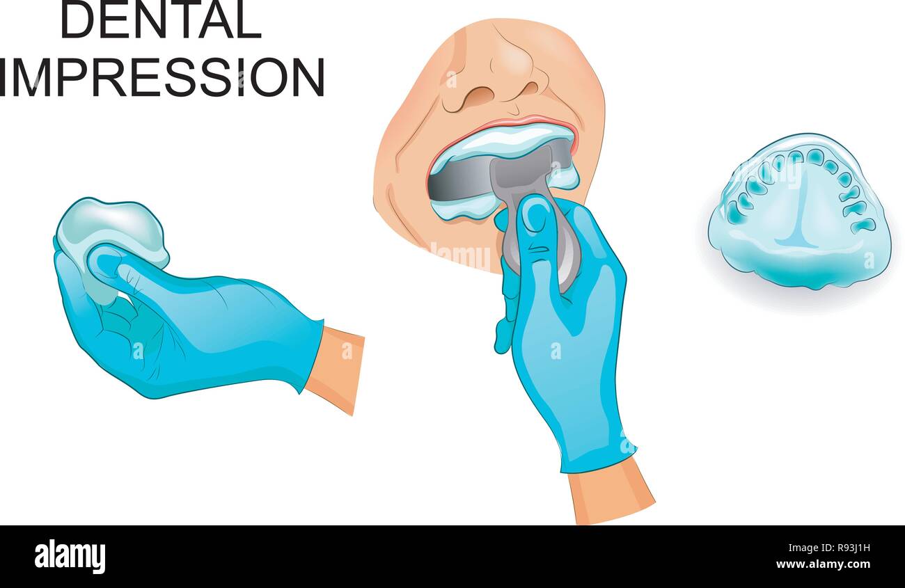 vector illustration of a dental cast of human teeth Stock Vector Image ...