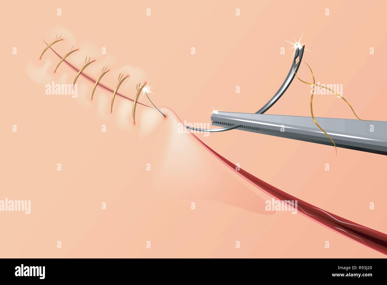 vector illustration of sewing up the wound with surgical needle Stock ...