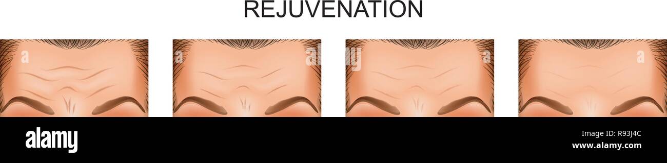 vector illustration of a rejuvenation of the skin of the forehead Stock ...