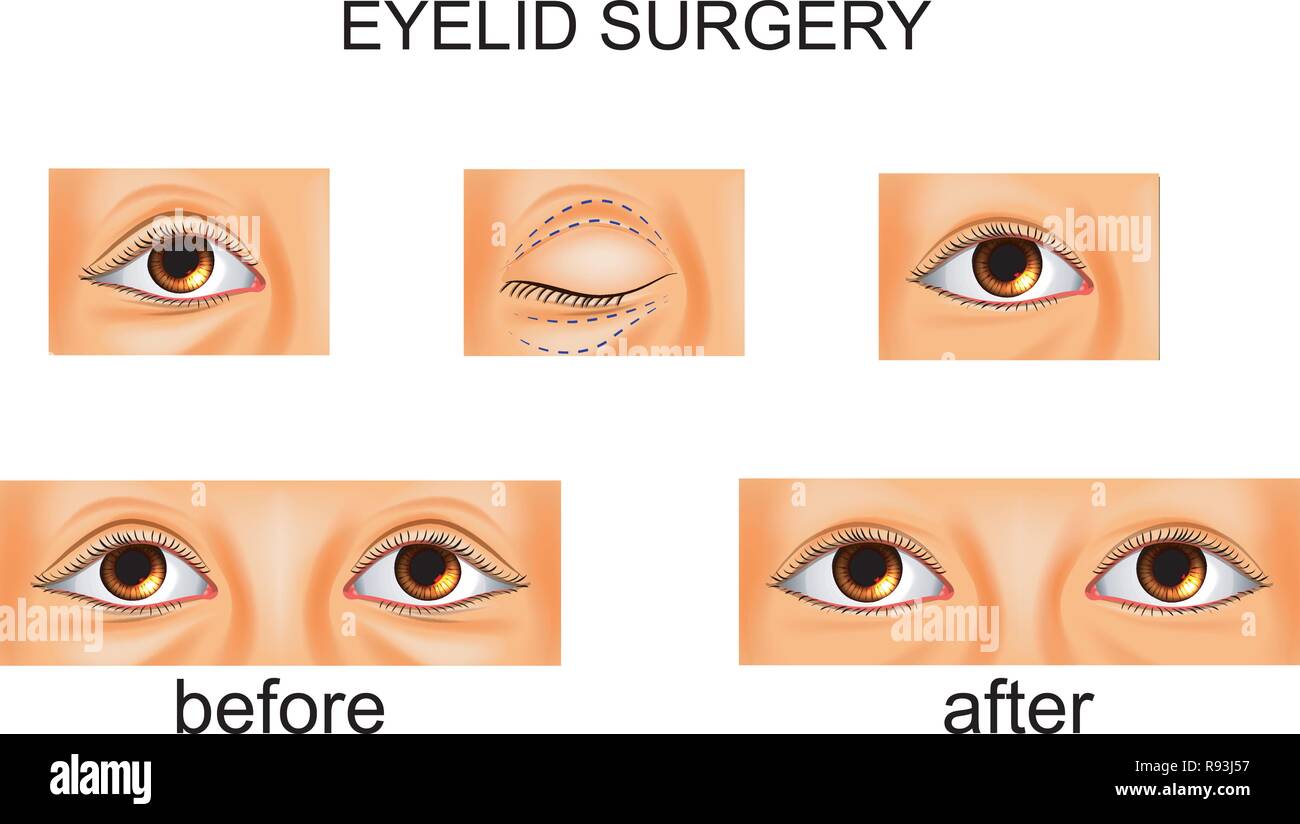 vector illustration of eyelid surgery, plastic surgery Stock Vector ...