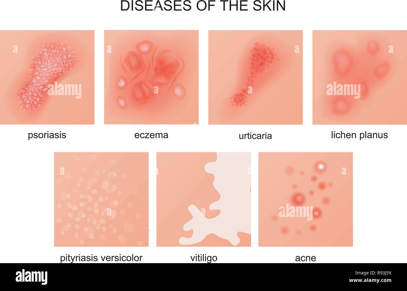 vector illustration of diseases of the skin Stock Vector Image & Art ...